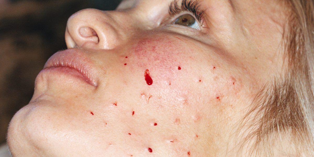 "Botox" for The Face Magazine. Photographed by Rosie Marks. – News ...